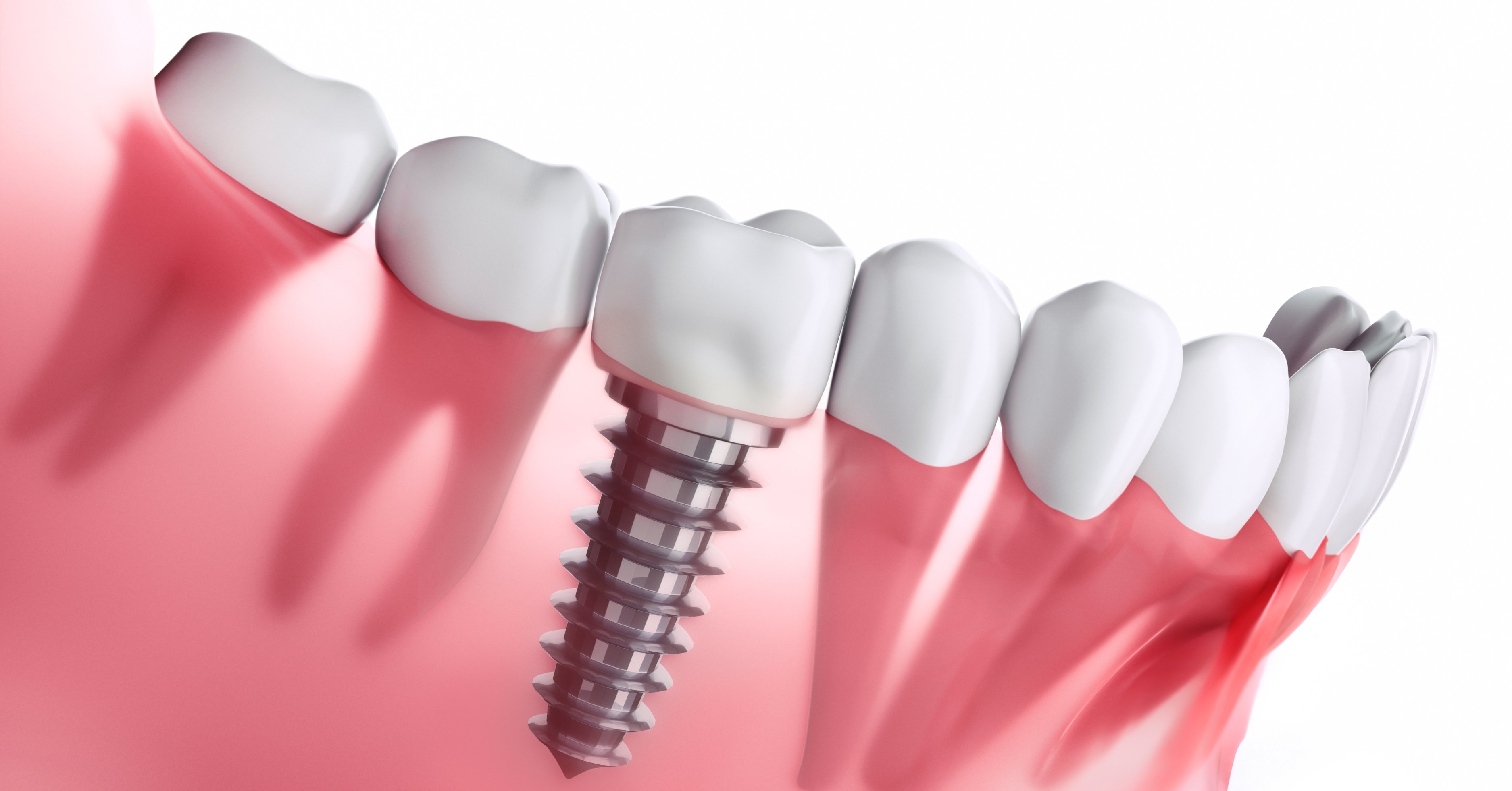 Can You Get an MRI with Dental Implants? What You Need to Know